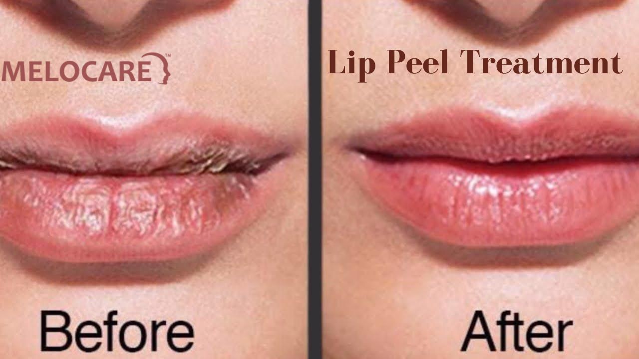Lip Peel Treatment in Delhi | Melocare